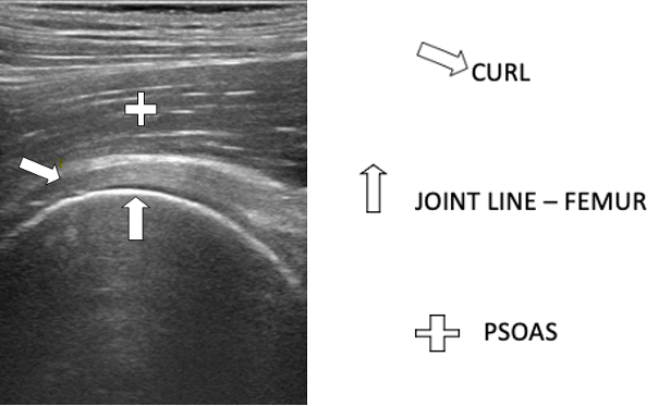 Intra-articular ultrasound-guided injections, description of the capsular ultrasound reference ...